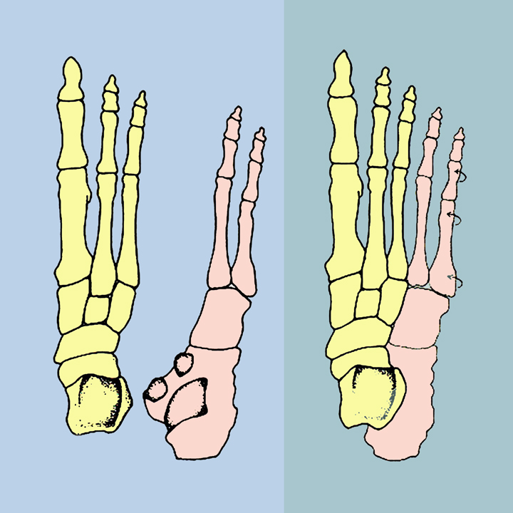There Are Three Arches of the Feet. Inner, Outer, and Transverse.
