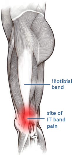 itb-syndrome-l | CoreWalking