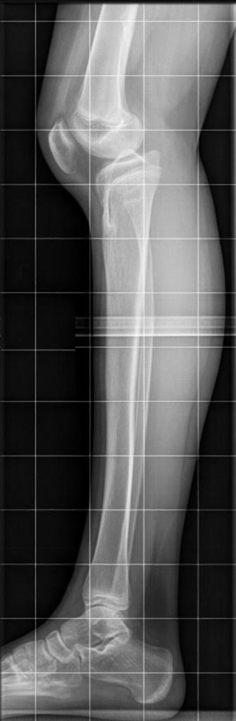 Please Stop Hyperextending Your Knees Right Now