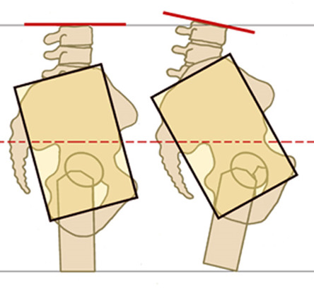 tucking-the-pelvis | CoreWalking