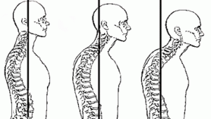 Forward Head Posture and Breathing