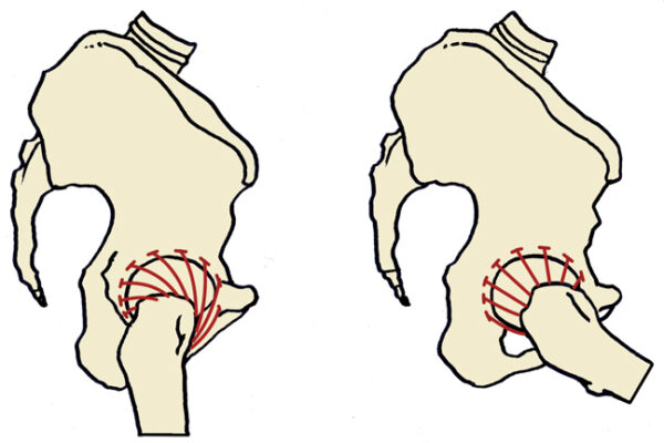 How the Femoral Head Sets the Stage for Healthy Movement: Anatomy ...